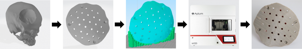 Case Study: Additive Manufacturing for Medical Applications - Apium 3D ...